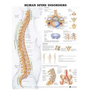 Human Spine Disorders Wall Chart | Remington Medical